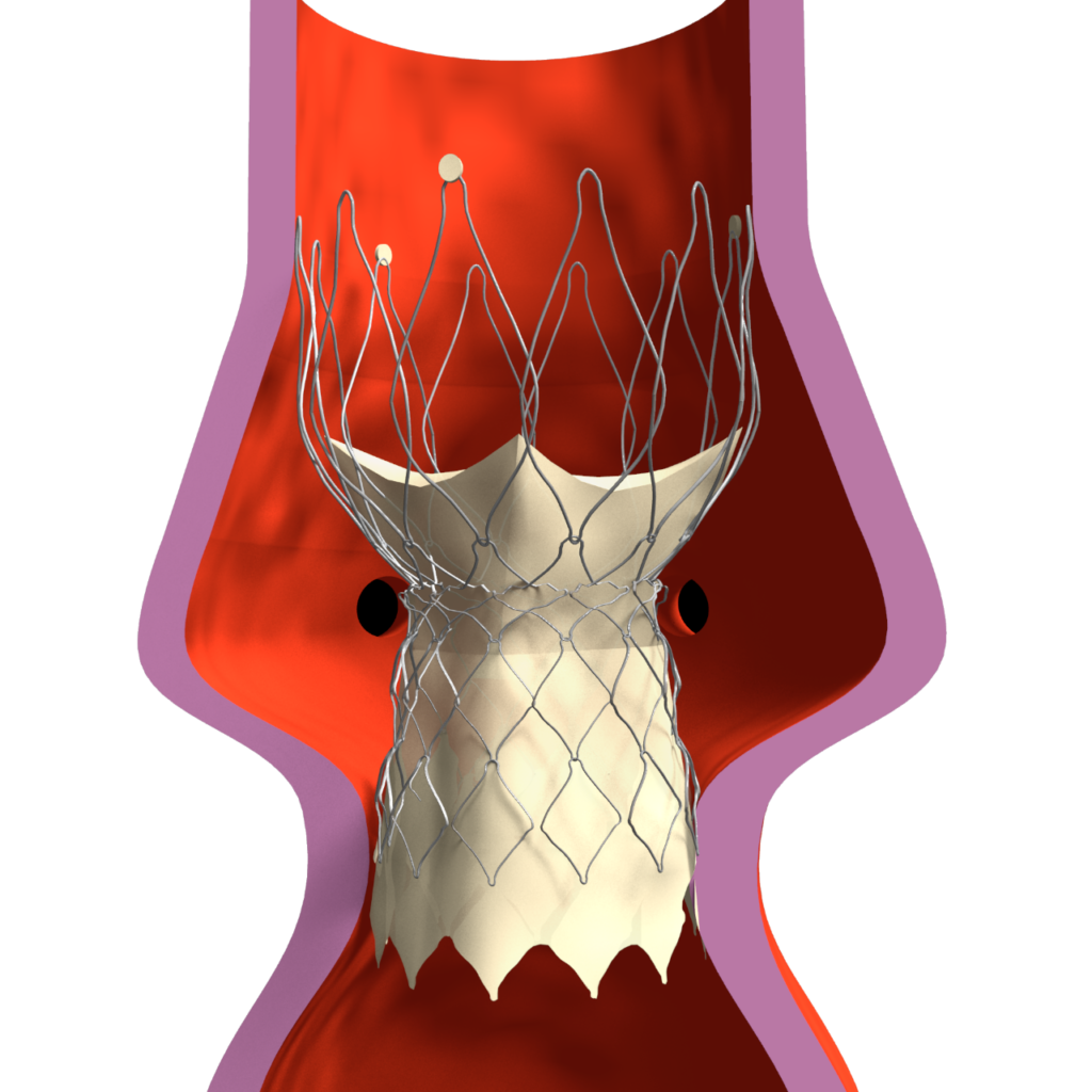 Heart Valve Frame - 古河テクノマテリアル